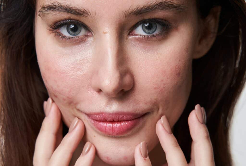 Acné : causes et traitements | Dr Tribout | Dermatologie esthétique ... Acné : causes et traitements | Dr Tribout | Dermatologie esthétique ...
