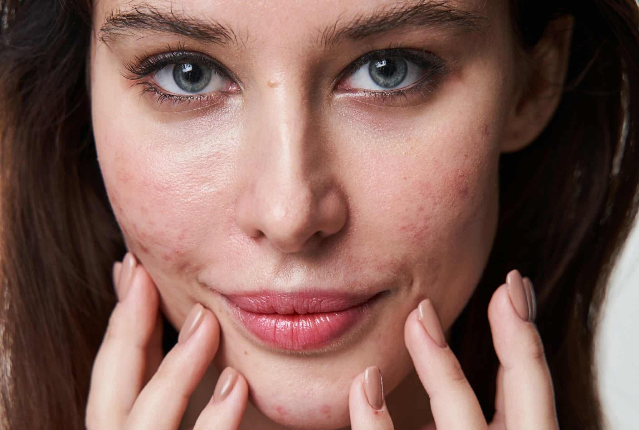 Acné : causes et traitements | Dr Tribout | Dermatologie esthétique ...