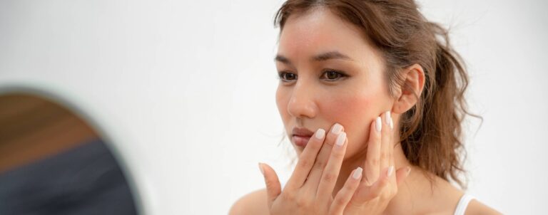 Comment se déclenche la rosacée sur le visage ? | Dr Tribout | Amiens