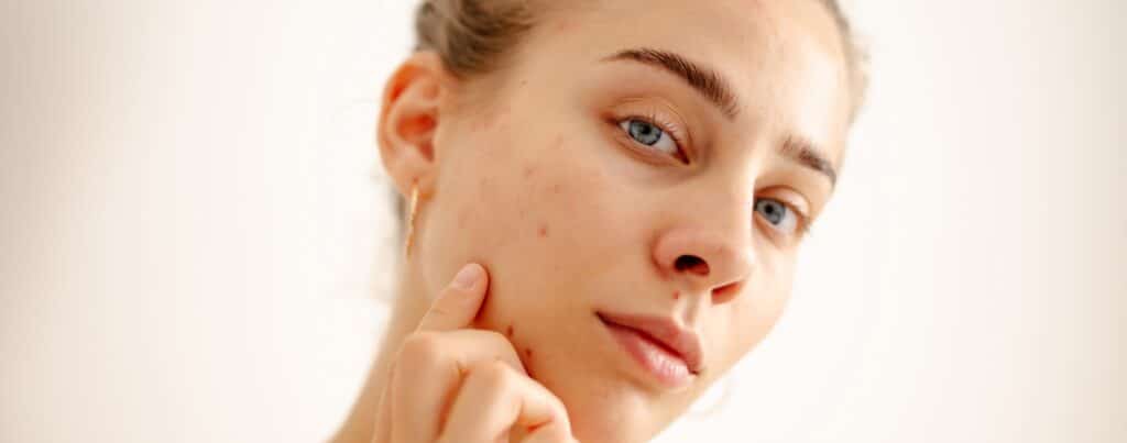 Comment traiter ses imperfections cutanées : boutons, microkystes ...